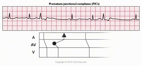 Premature Junctional Contraction Wiki