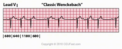 EKG, ECG Interpretation Course | CEUfast Nursing Continuing Education